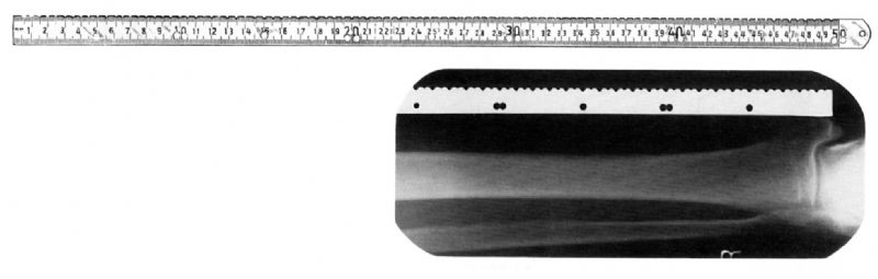 RULER FOR X-RAY WORK IN FRACTURE TREATMENT