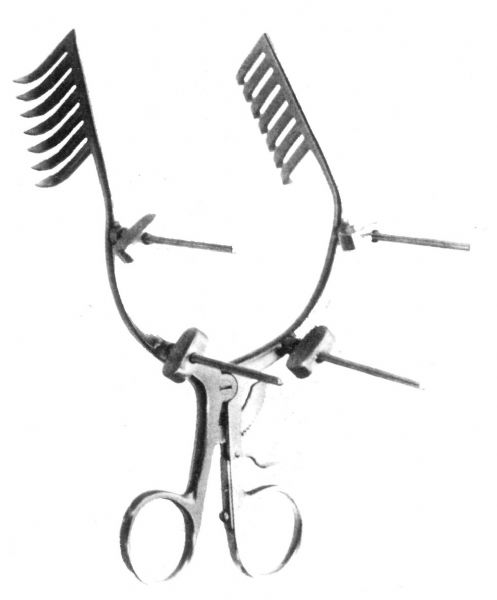 MISKIMON SELF-RETAINING RETRACTOR ONLY